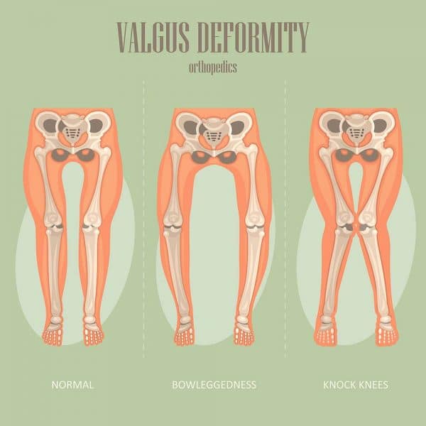 Knee Valgus How To Fix Knock Knees Elite Feet